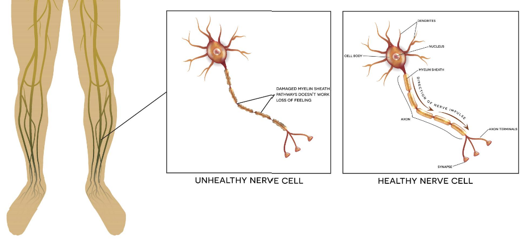 Neuropathy Information - Select Health of the Carolinas